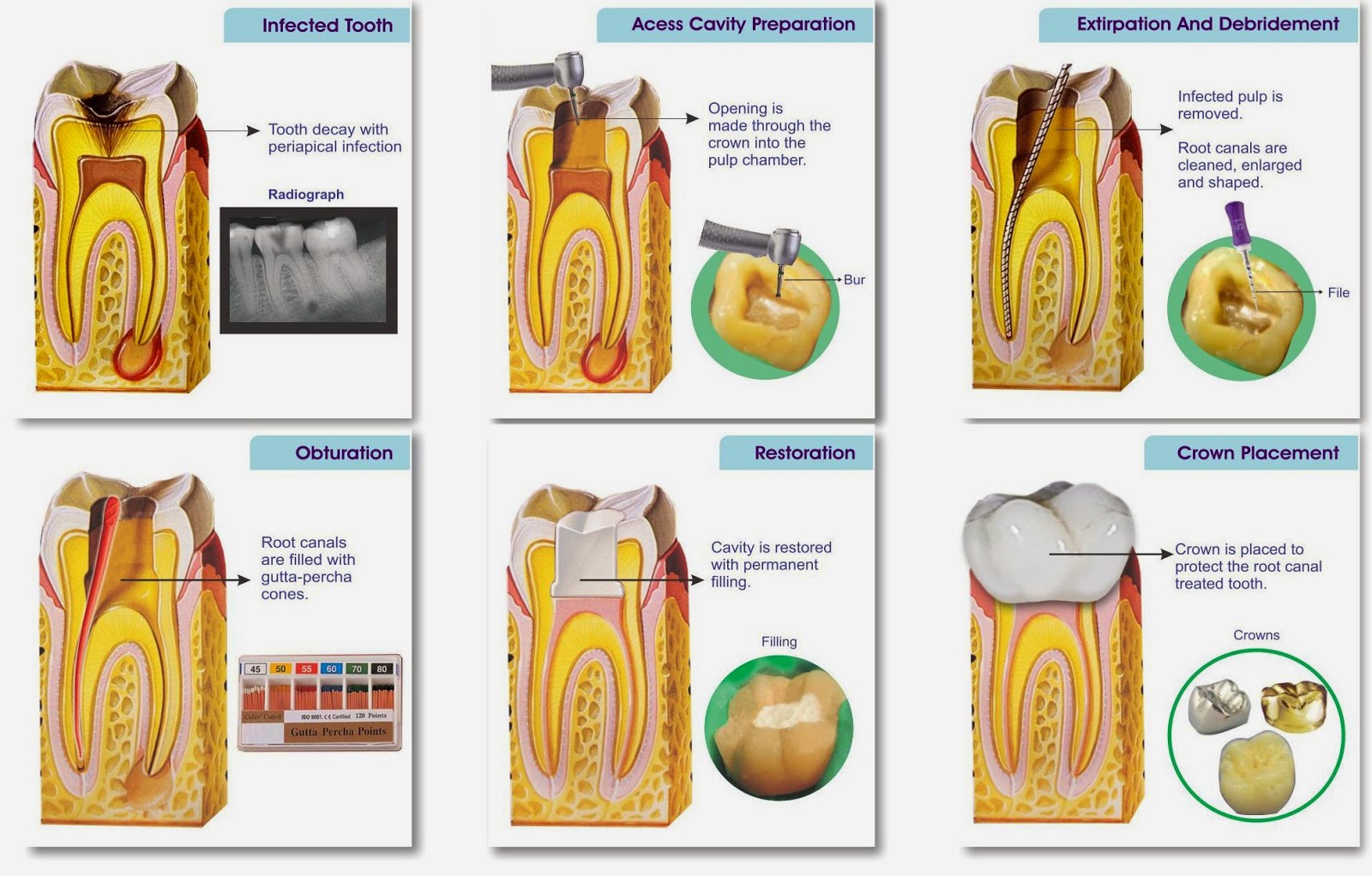 Best Dental Care In Kerala | Dental Specialities Centre: Root Canal ...