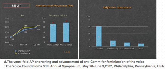 Voice Feminization Surgery
