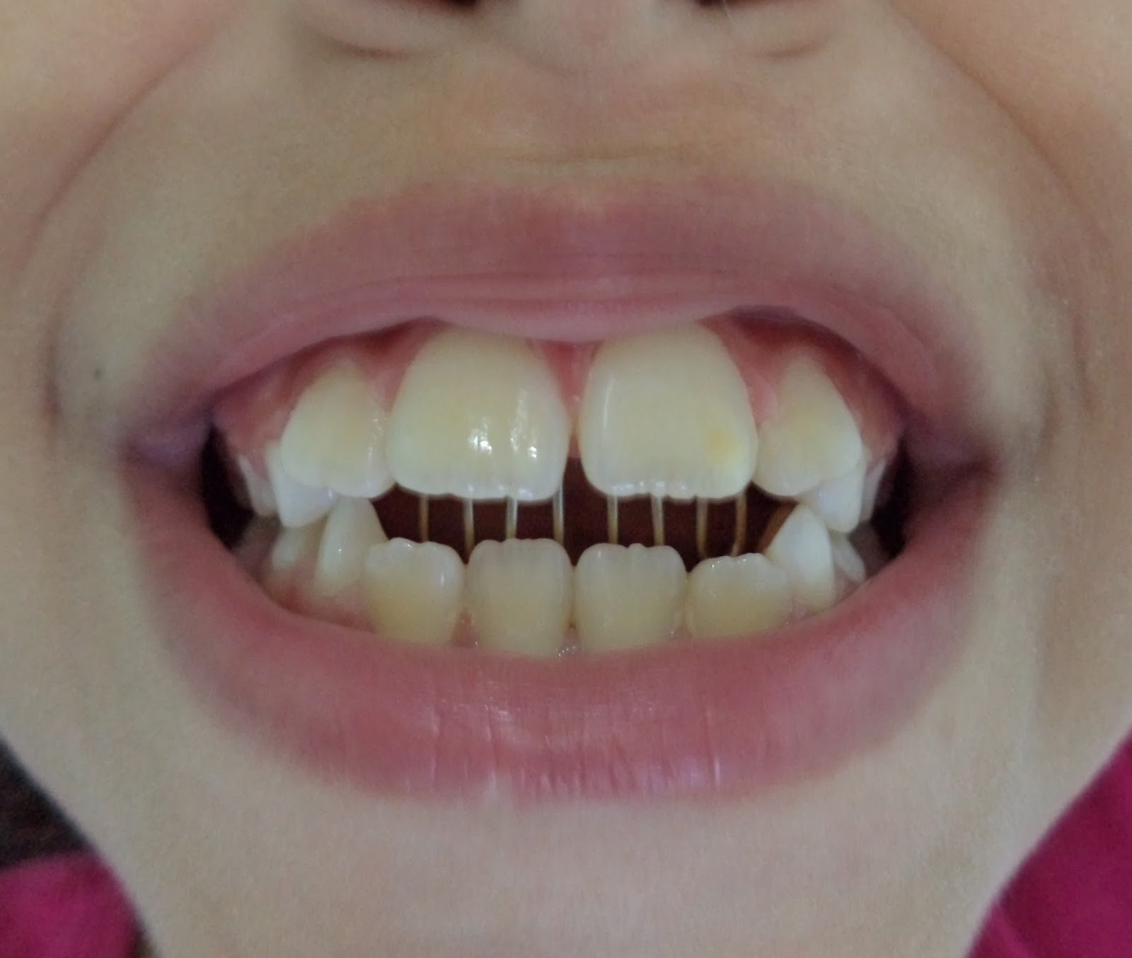 Blog do Dentista: Mordida aberta- atualização Blog do Dentista: Mordida aberta- atualização