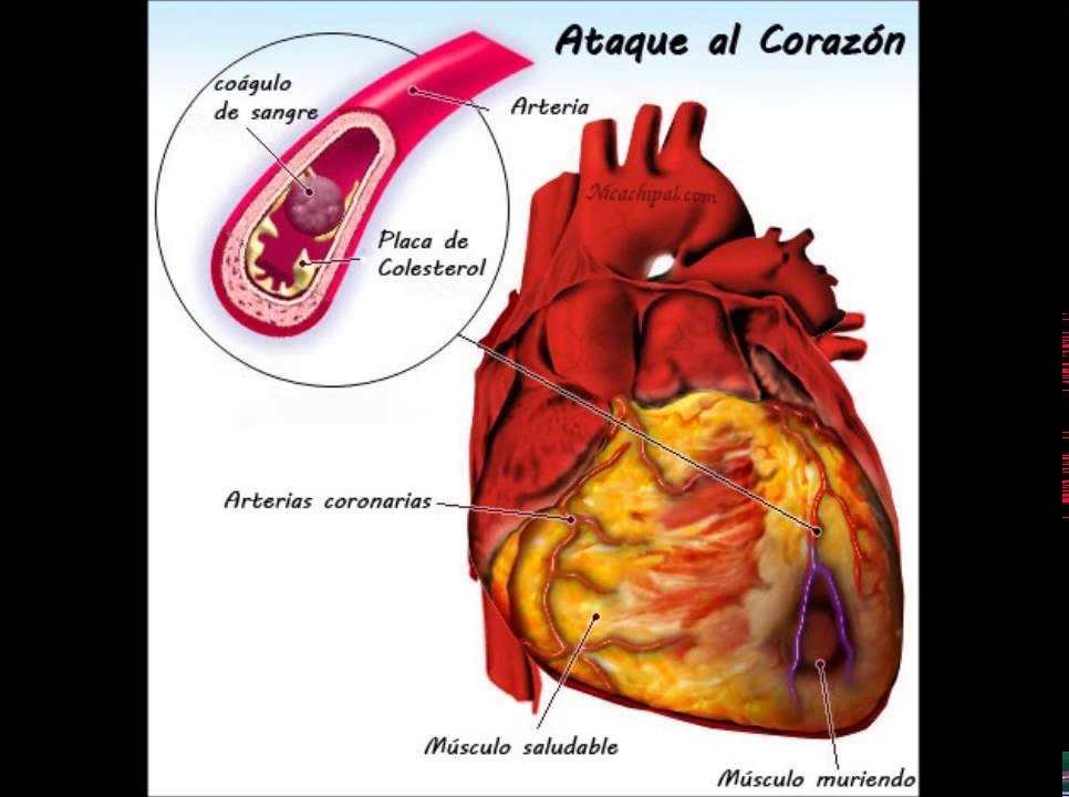 LA BIOLOGÍA EN EL CINE Y LAS ARTES: INFARTO AL CORAZÓN. EL TRIPLE ...
