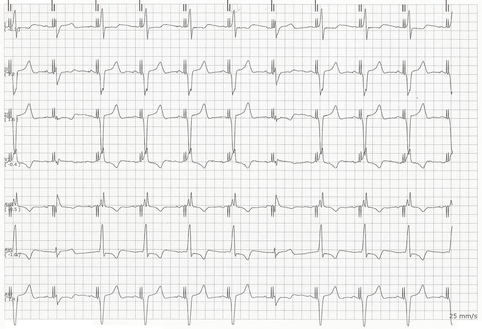 Biventricular Pacing