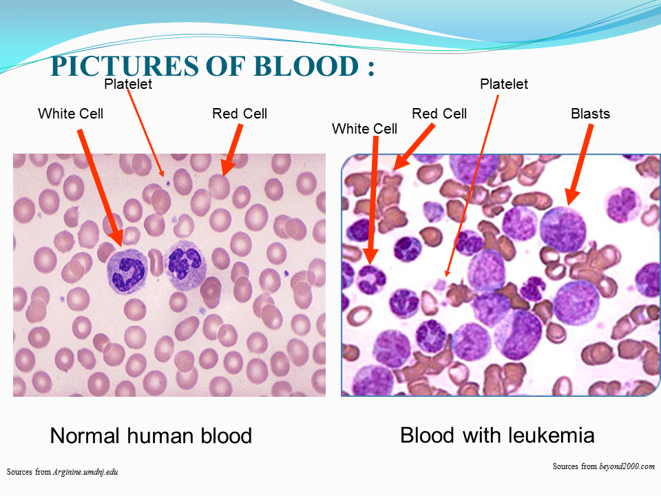 Leukemia, Epidemiologi, Patogenesis, Leukemia Akut