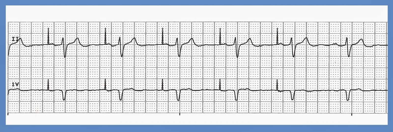 Various Atrial Paced Rhythms