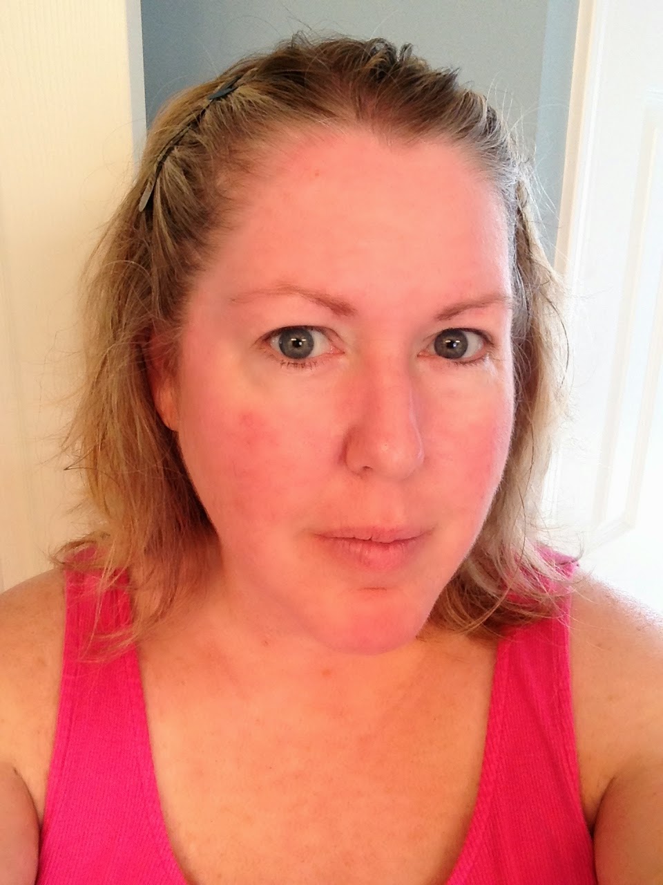 My Journey Through Topical Chemotherapy - Fluorouracil 5% Cream and ...