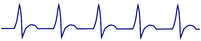 Accelerated Idioventricular Rhythm (AIVR) Atau Ritme Idioventrikular ...