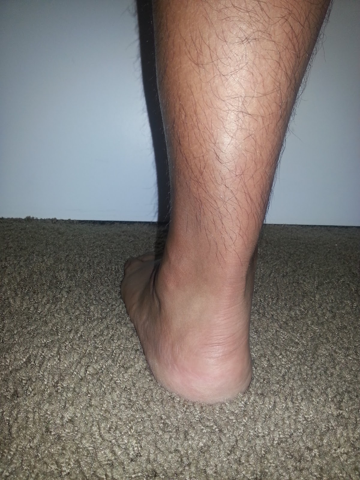 Peroneal Tendon Surgery Recovery: Ankle Time Line (updated for week 10/11)