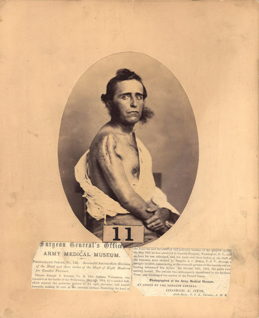 Eerie Vintage Portraits of Wounded Soldiers During the American Civil ...
