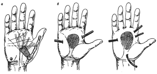Медична скарбниця: Флегмони кисті: хірургічне лікування