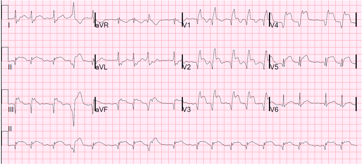 Dr. Smith's ECG Blog: Large Transmural STEMI with Myocardial "Rupture ...