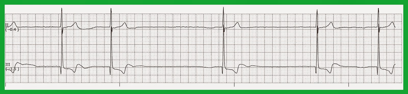Various Atrial Fibrillations