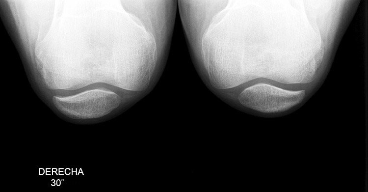 Esculapio Hijo del Sol: Rótula