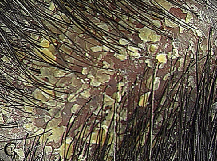Seborrheic Dermatitis; Skin Condition