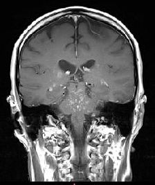 Living With CLIPPERS: Four Week Journey to Diagnosis
