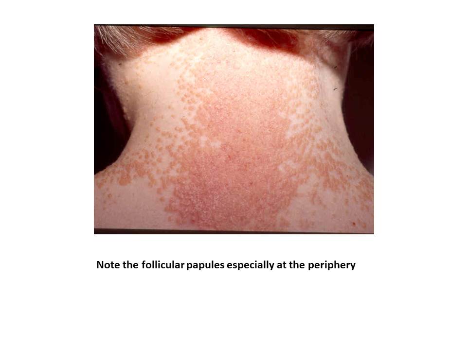 Consultations in Dermatology: Pityriasis Rubra Pilaris