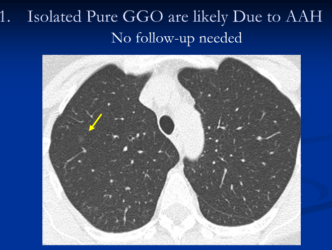 rsna: GGO lung nodule guideline