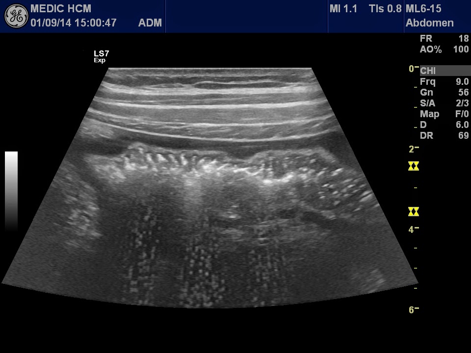 VIETNAMESE MEDIC ULTRASOUND: CASE 272: EOSINOPHILIC GASTROENTERITIS and ...