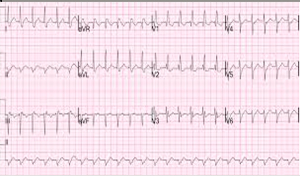 Paroxysmal Supraventricular Tachycardia
