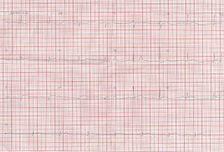Blog de Eletrocardiografia: O VALOR DAS DERIVAÇÕES PRECORDIAIS DIREITAS ...