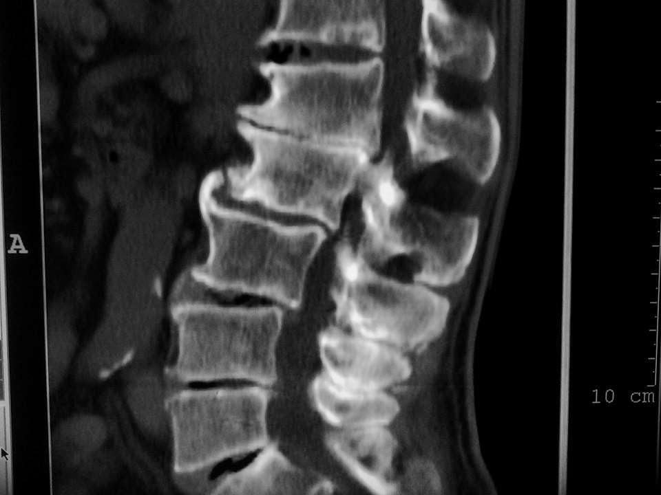 Movirsen: CASO CLÍNICO: Columna Lumbar