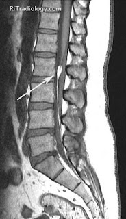 RiT radiology: Lipoma of Filum Terminale