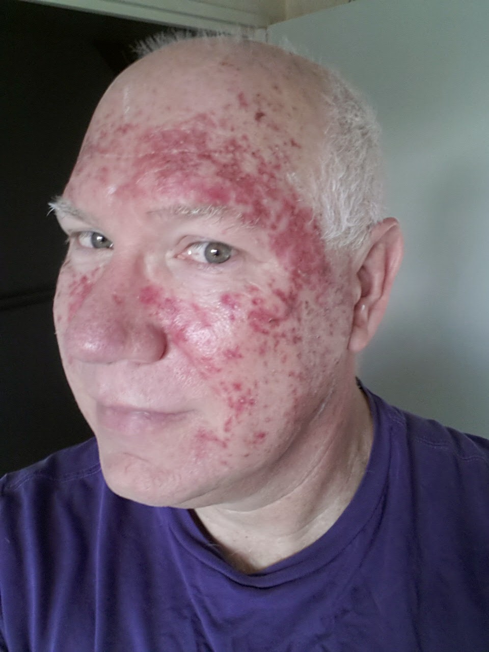 Resultaat gebruik Efudix: Dag 14