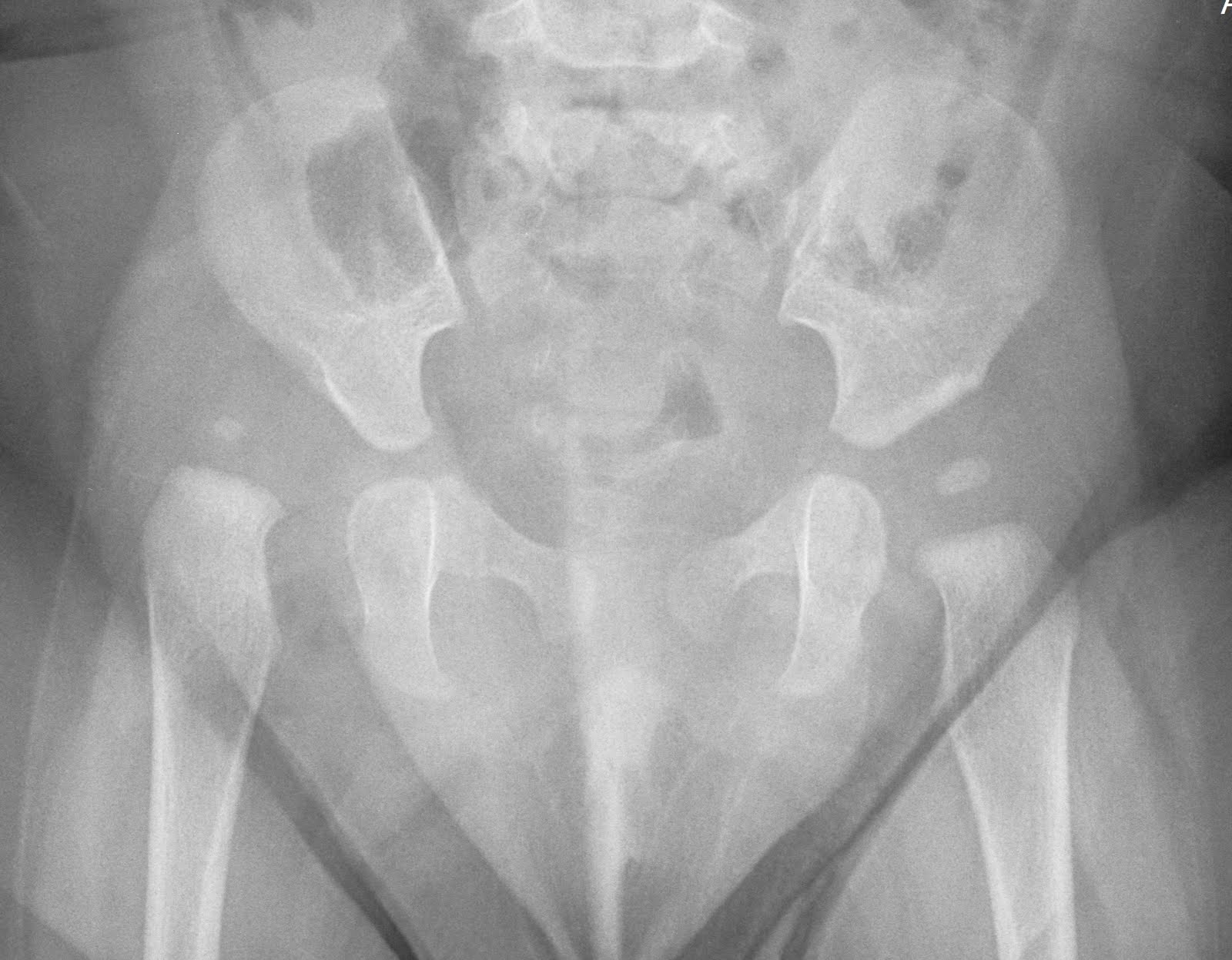 Our Sweet Ev: Developmental Dysplasia of the Hip
