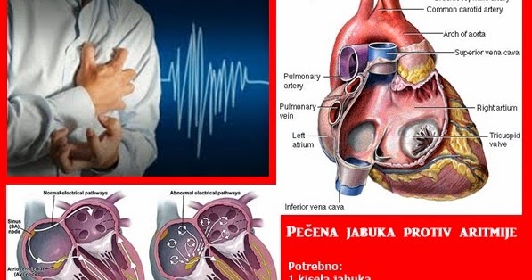 Aritmija srca - simptomi i liječenje | Journal de Luxe - #MItoTako