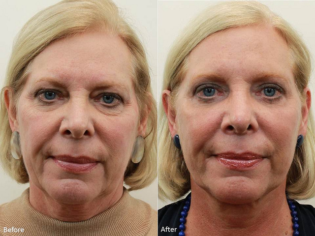 Dr. Darm, Aesthetic Medicine Blog: Natural-look facelift before and ...