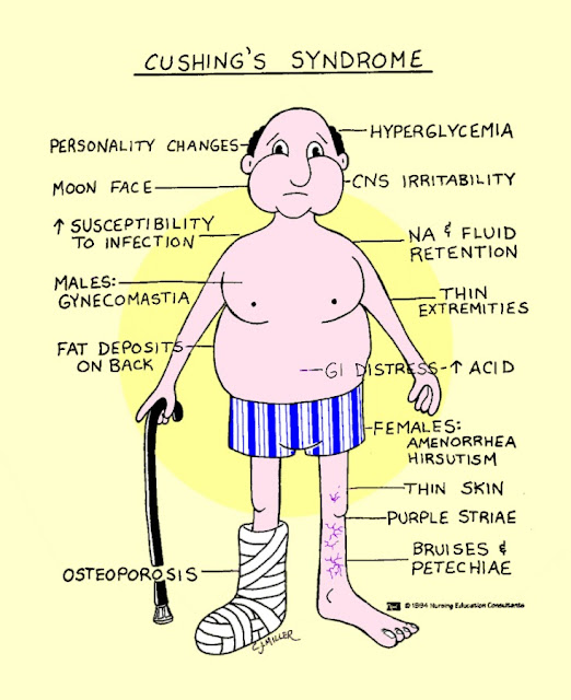 Cushing syndrome