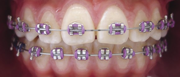 Odontología: Ortodoncia (Brackets)