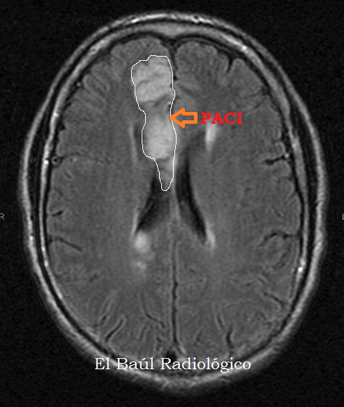 El Baúl Radiológico: ICTUS: UN GALIMATÍAS DE SIGLAS (Stroke: A ...