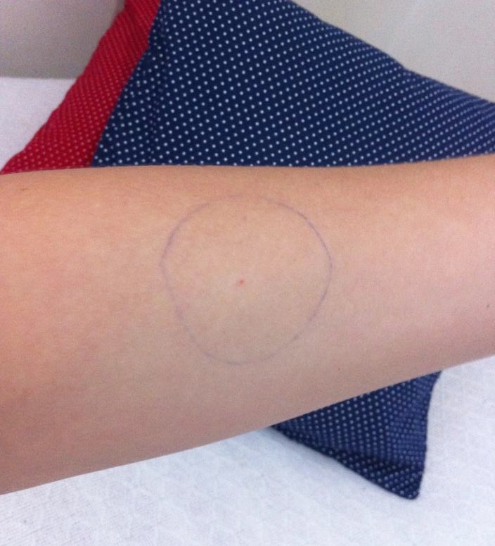 Brazuca na Estrada: Teste de Tuberculose - PPD