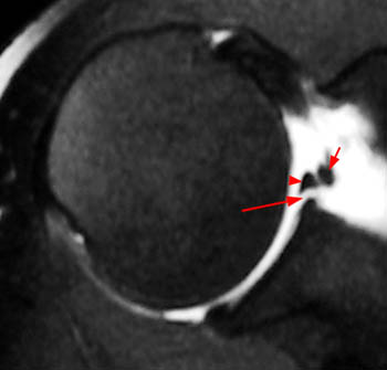 MRI Musculo-Skeletal Section: Labrum