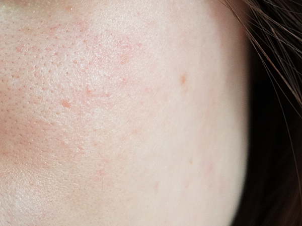 Plaque peau seche - aris68deoproh