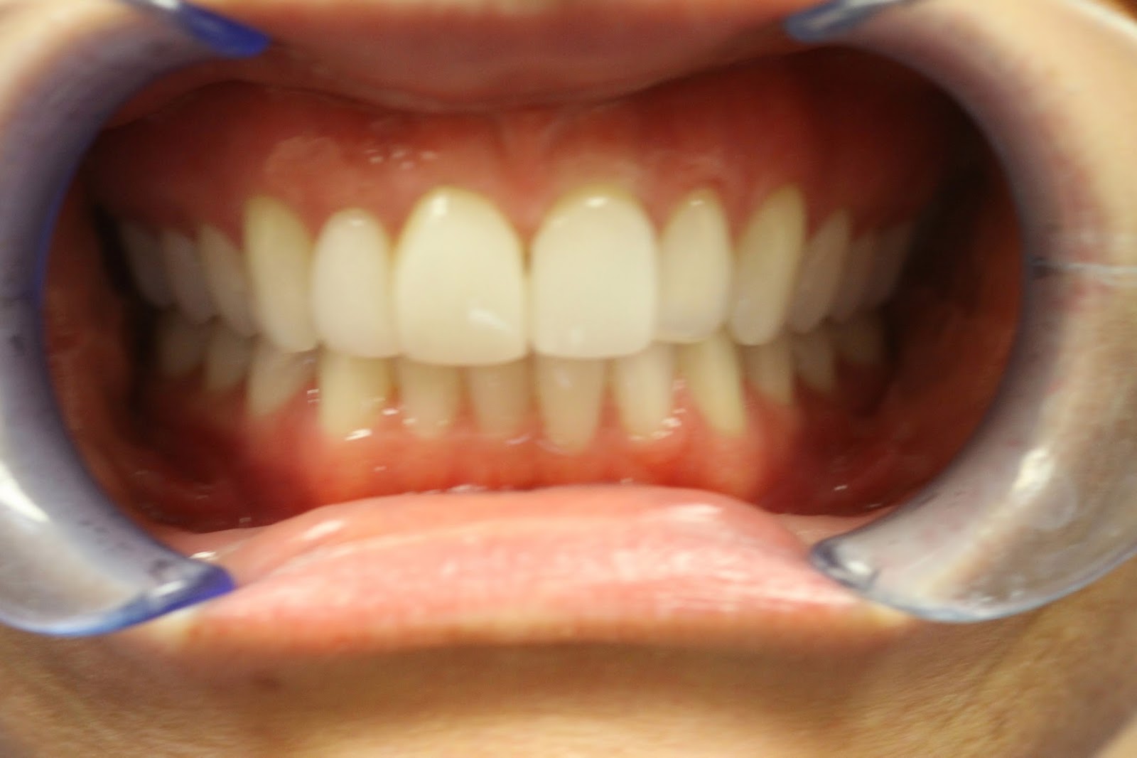 Lauren's Invisalign blog: Retainers | SmilesRForever