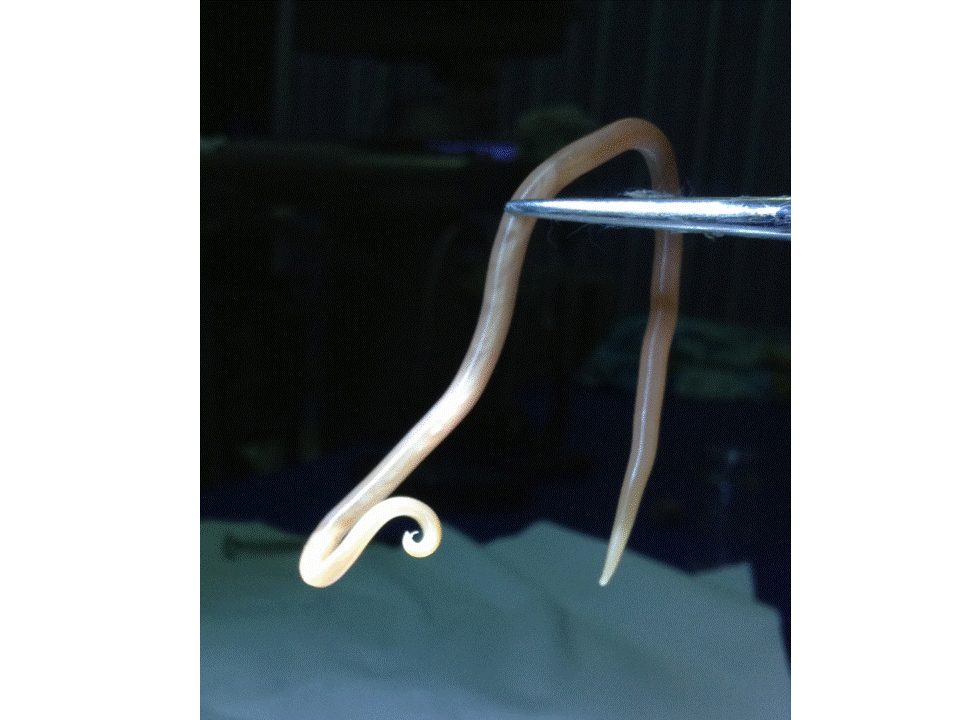 VIETNAMESE MEDIC ULTRASOUND: CASE 194: ASCARIS in CBD and ULTRASOUND ...