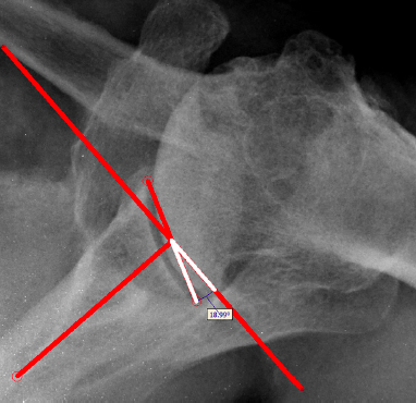 UW Shoulder and Elbow Academy: Glenoid version measurement - does CT ...
