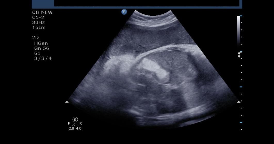 Ultrasound imaging: Echogenic Fetal bowel-an intriguing case