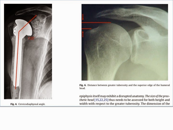 Shoulder and Elbow Surgery: The radiographic analysis of a total ...