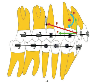 ORTODONTIA CONTEMPORÂNEA: Mini-implantes vs aparelhos funcionais fixos ...