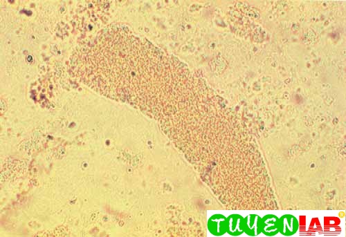 Atlas of Casts in urine | Free Medical Atlas