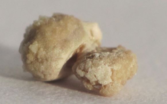 Kidney Stone Treatment: kidney stone causes