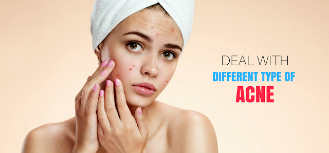 How to Deal with Different Type of Acne? - Skin Care Blog - Clinica ...