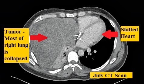 Roberto Fights Cancer!: CT Scan Comparisons