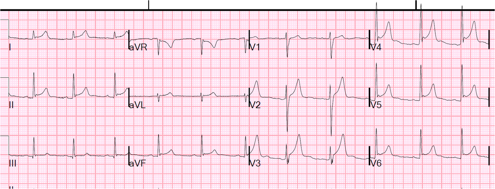 Benign Early Repolarization