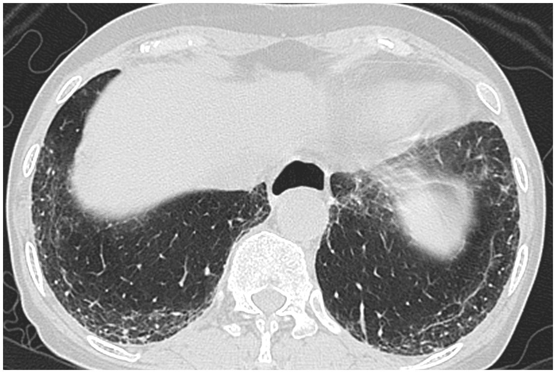 RADIOLOGY IMAGE SPOTTERS: Scleroderma - axial CT section