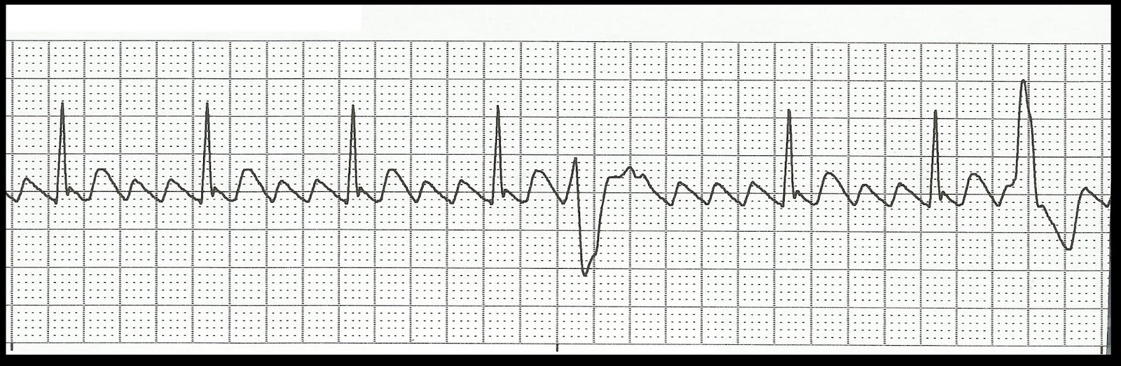 Practice EKG Rhythm Strips 173