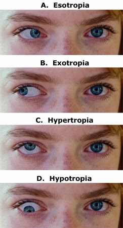 STRABISMUS: Misaligned or Turned Eyes