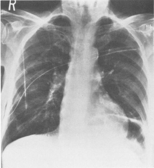 Centro de Terapia Semi-Intensiva Hospital de Clínicas - UFPR: TÓRAX DE ...