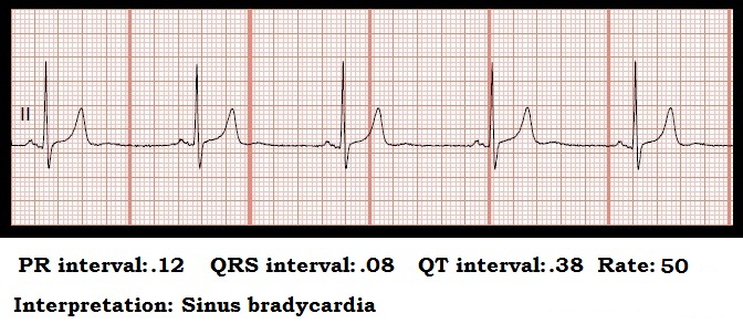 ECG Rhythm Strip Quiz 101: Interval measurements